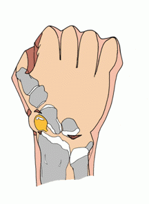 Ganglion Cyst - Chirurgia della mano - Dr Loris Pegoli